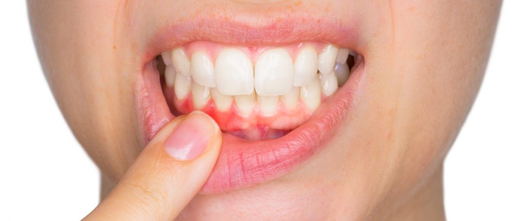 Parodontite chronique : causes, symptômes et traitements possibles